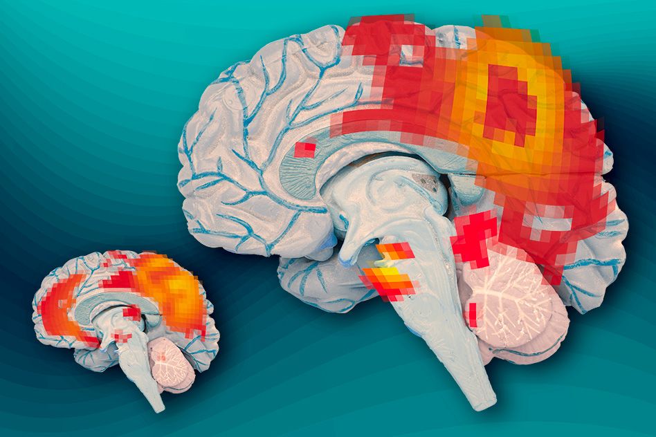 Inside The Adult ADHD Brain MIT News Massachusetts Institute Of