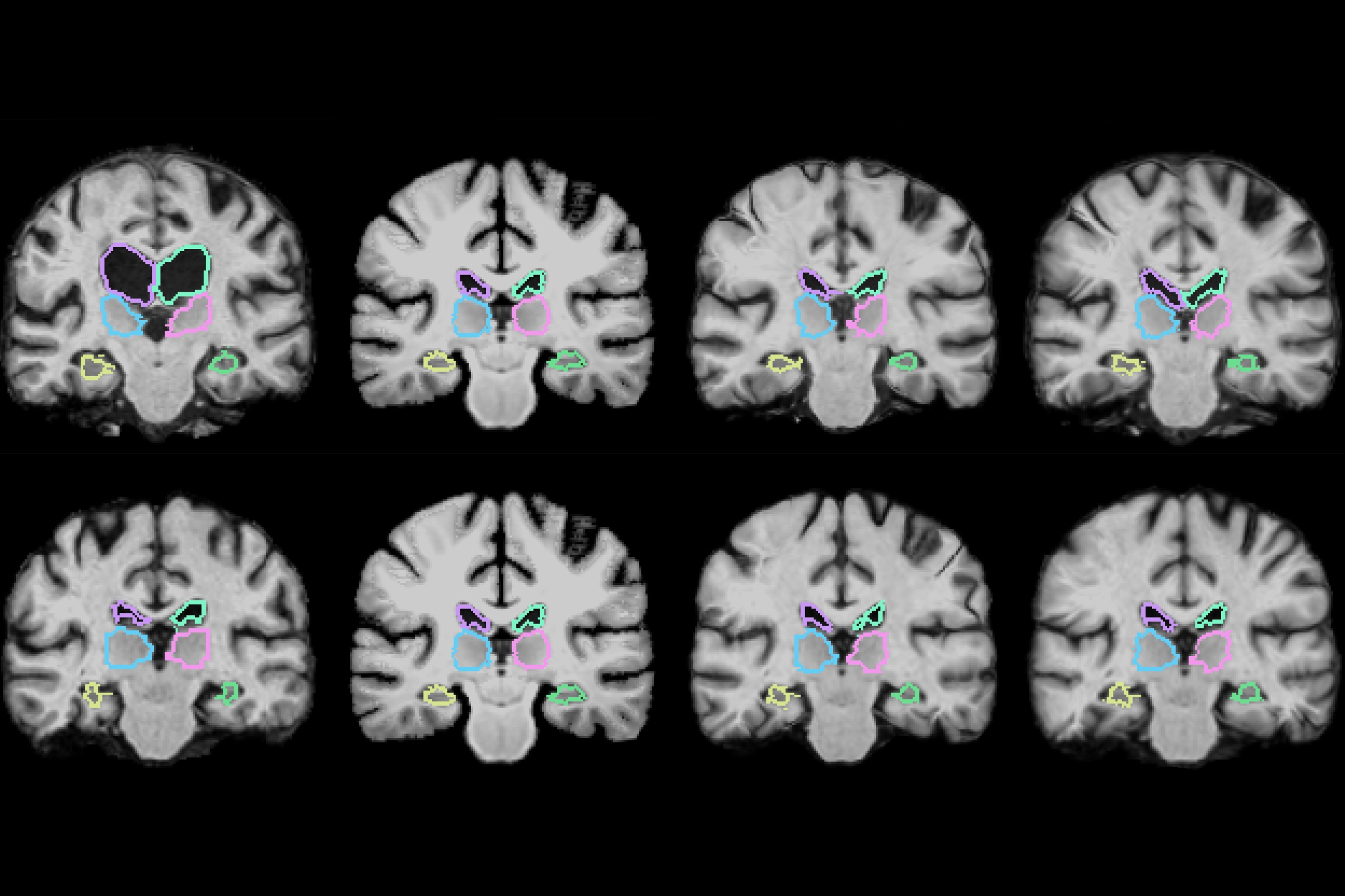Intelligent Brain Mri
